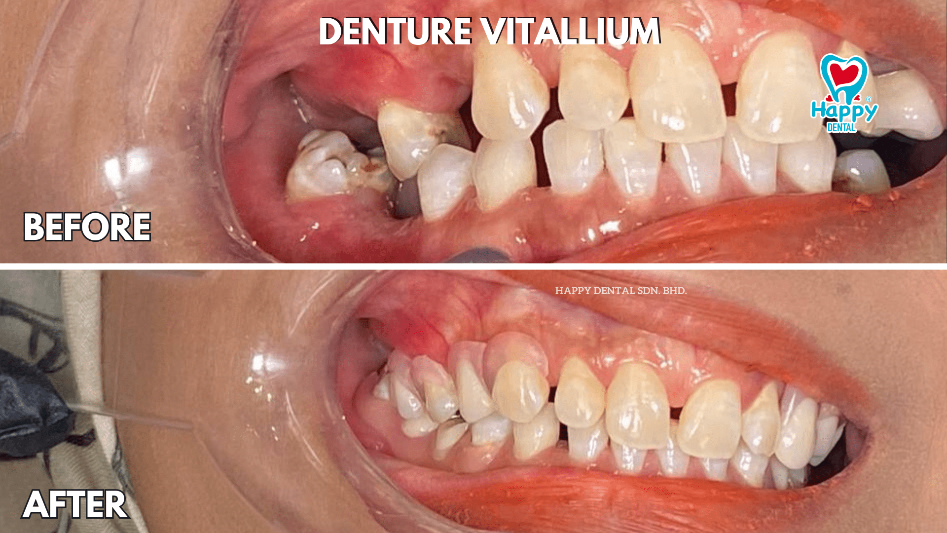 Denture – Klinik Happy Dental