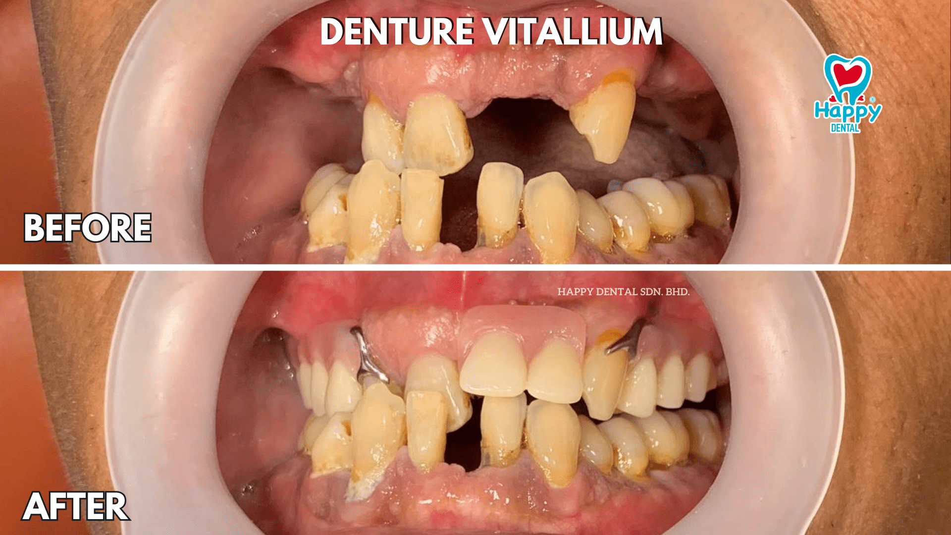 Denture – Klinik Happy Dental