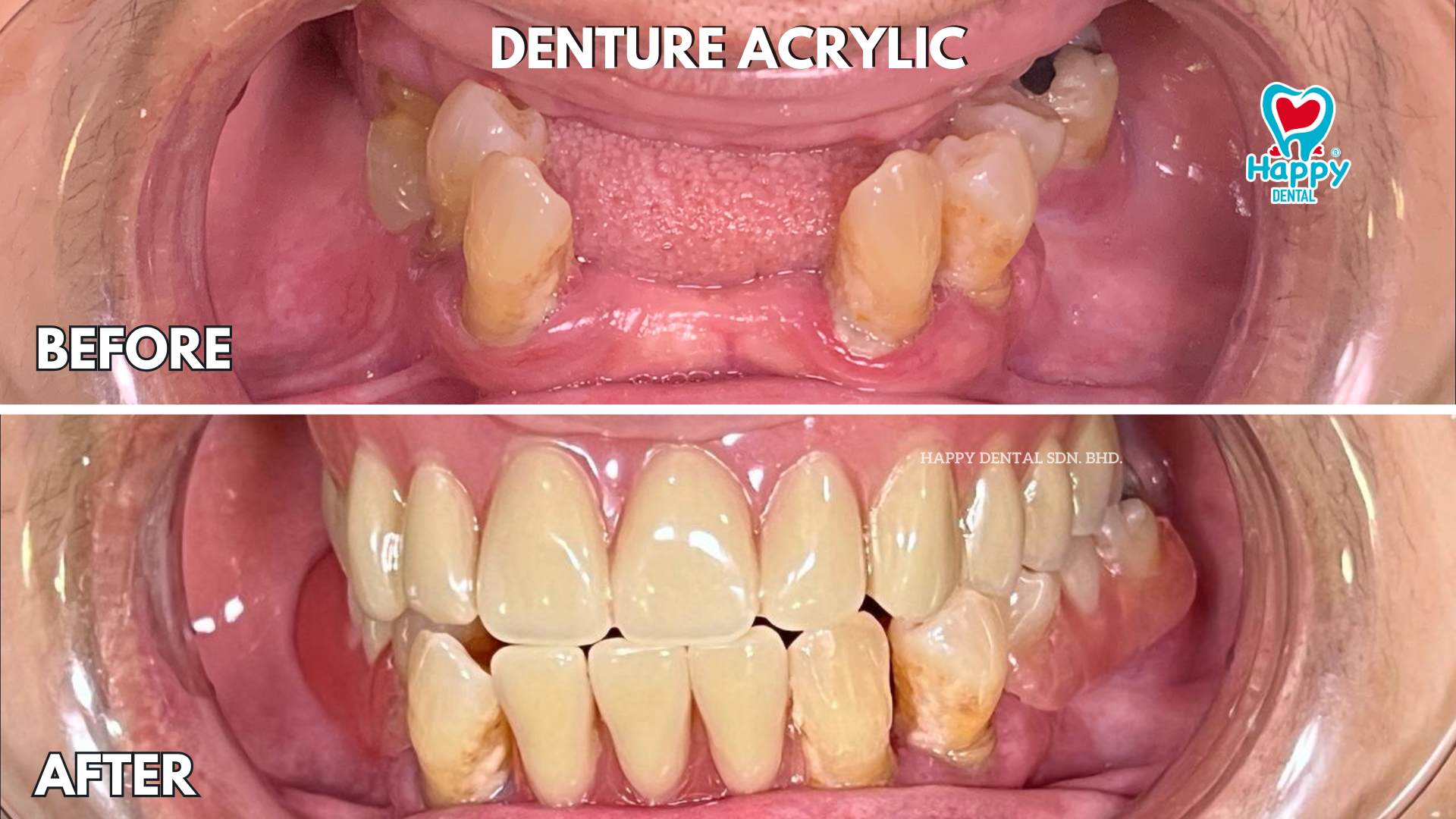 Denture – Klinik Happy Dental